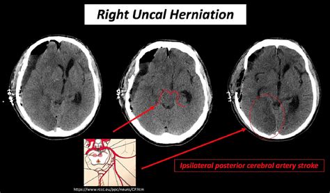 Figure 2 From Understanding Brain Herniations Semantic Scholar