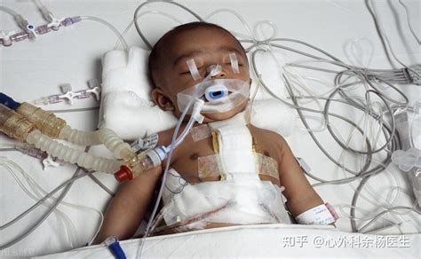 法洛氏四联症（先天性心脏病）有哪些症状表现！ 知乎