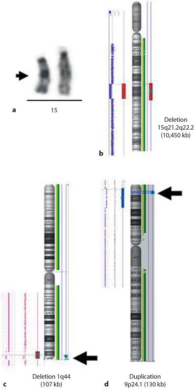 Cytogenetic And Affymetrix Cytoscan Hd Array Analysis A Interstitial