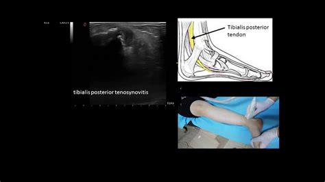 Posterior Tibial Tendon Synovitis