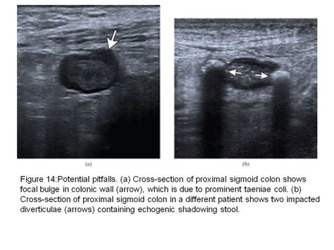 BÀi SoẠn VỀ SiÊu Âm ChẨn ĐoÁn Colonic Polyps Us Detection