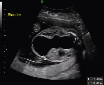 Prune Belly Syndrome Radiology Key