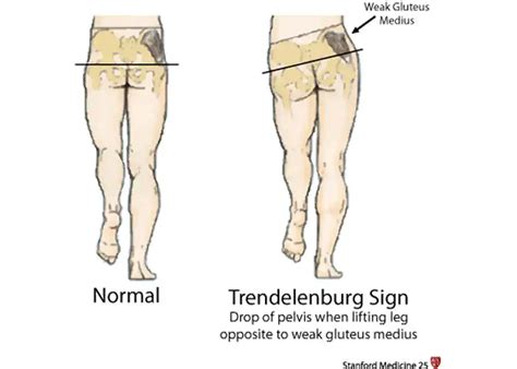 Trendelenburg Gait Causes Signs And Treatment