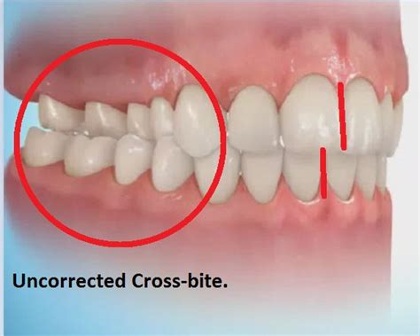 Crossbite Correction