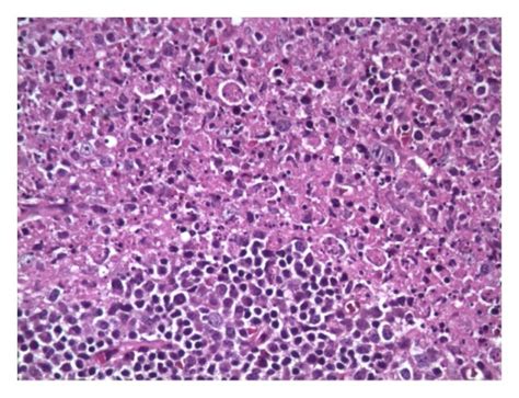 High Magnification Lymph Node With Abundant Karyorrhectic Debris With Download Scientific