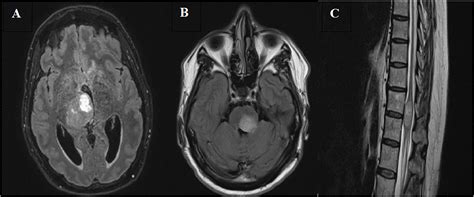 An Update On H3k27m Altered Diffuse Midline Glioma Diagnostic And