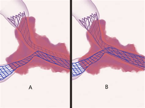 Strategy For Ercp Stenting In Cholangiocarcinoma