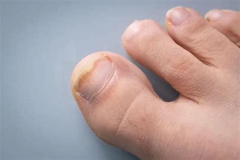 Toenail Fungus Infection Early Stage Pictures Before And After