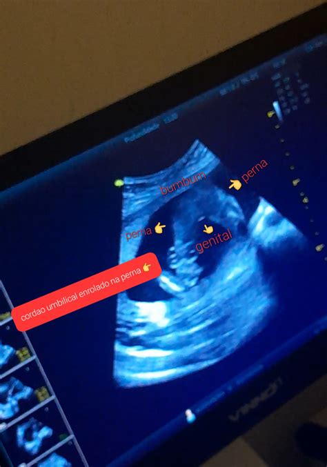 Ultrassom E Nada De Saber O Sexo BabyCenter