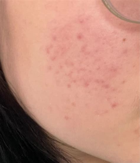 여드름 붉은자국 치료 지식in