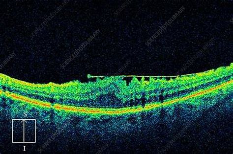Epiretinal Membrane Oct