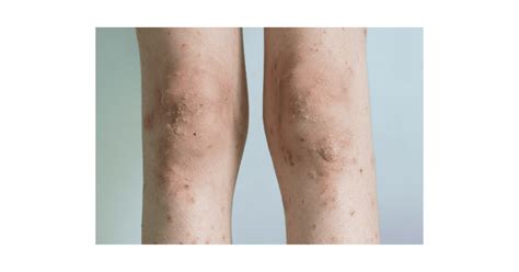 Whats The Difference Between Eczema Vs Rosacea 2025 Comparison