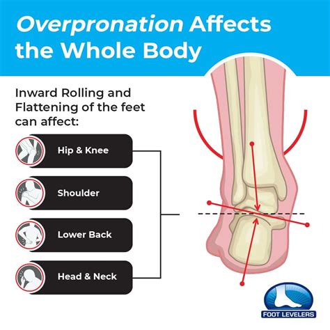 Custom Orthotics Chiropractic Spine Wellness Upright Spine Center
