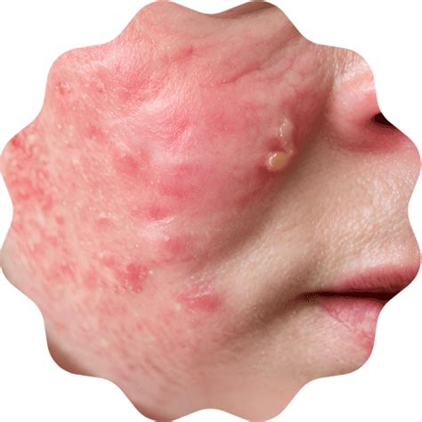 Acne And Acne Scars Treatment And Removal In Malaysia