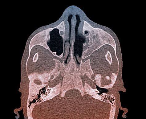 Bone Damage In Hyperparathyroidism Photograph By Zephyr Science Photo