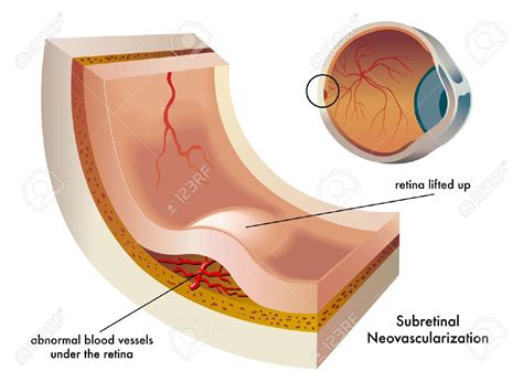 Subretinal Neovascularization Stock Vector Retina Ophthalmologist In Frederick Md Greater