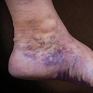 Other Types Of Venous Disease Usa Vein Clinics
