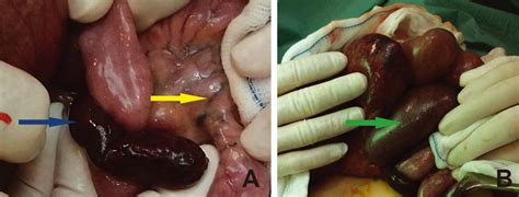 Necrotic Meckels Diverticulum Obstructing The Ileum Blue Arrow