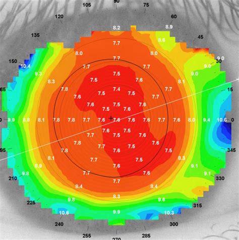 Using Tangential Topography Kerasoft