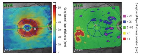Consider Age Sex Axial Length When Measuring Gcl Thickness On Oct