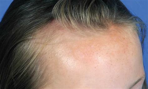 Congenital Triangular Alopecia Causes Symptoms Diagnosis And Treatment