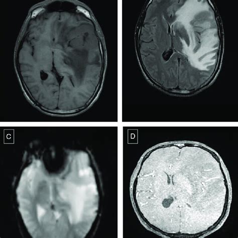 Cerebral Mri Shows An Extra Axial Tumoral Process With Heterogeneous Download Scientific