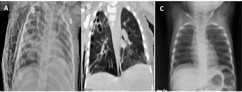 Lymphangioleiomyomatosis Lam Presenting As Recurrent Pneumothorax In