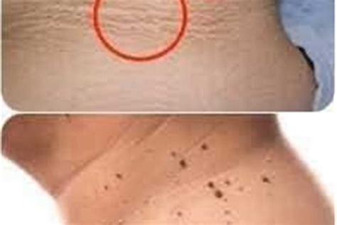 مؤشر على مرض خطير ما أسباب ظهور سواد فى الجلد أو زوائد جلدية