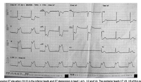Figure 1 From Clinical Significance Of St Segment Elevation In Posterior Leads V7 V8 And V9 In