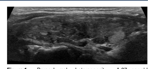 Figure 1 From Sonographic Features Of Diffuse Hashimoto Thyroiditis Determining Sensitivity Of