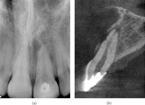 Figure 1 From Use Of Cone Beam Computed Tomography In Endodontics Semantic Scholar