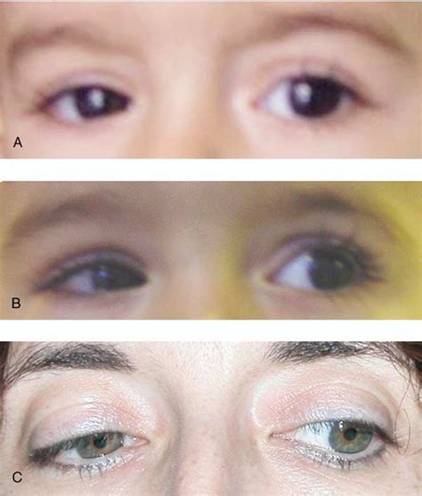 Levator Abducens And Medial Rectus Orbicularis Synkinesis Complex