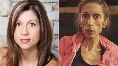 Rachael Farrokh La Actriz Anoréxica Que Pesa Solo 20 Kilos Recauda 127000 Euros