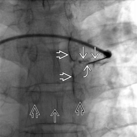 Selective Nerve Root Block Thoracic Spine Clinical Tree