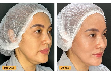 Regenerasi Kulit Dapatkan Kulit Sehat Dan Segar Smartxidelaser Id