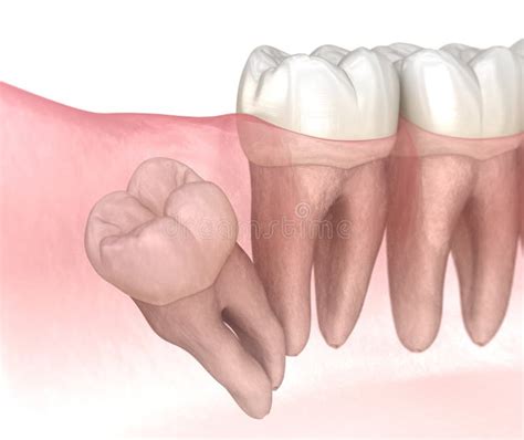 Distal Impaction Of Wisdom Tooth Medically Accurate Tooth 3d