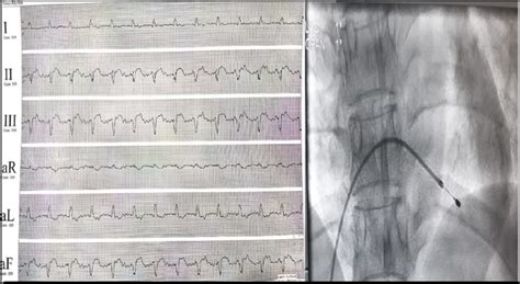 Transvenous Temporary Pacemaker Was Successfully Implanted With Setting