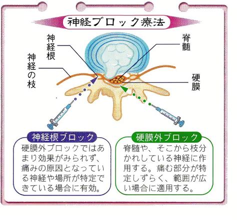 神経ブロック注射 西牧整形外科クリニック