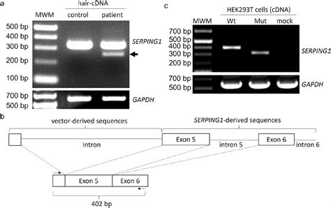 Characterization Of A Unique Pathogenic Variant In The Serping1 Gene Of