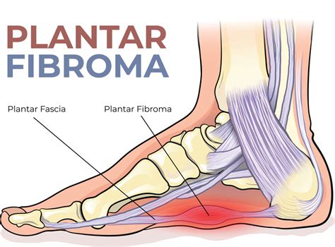 Blog How To Treat A Plantar Fibroma Burleson Fort Worth Tx