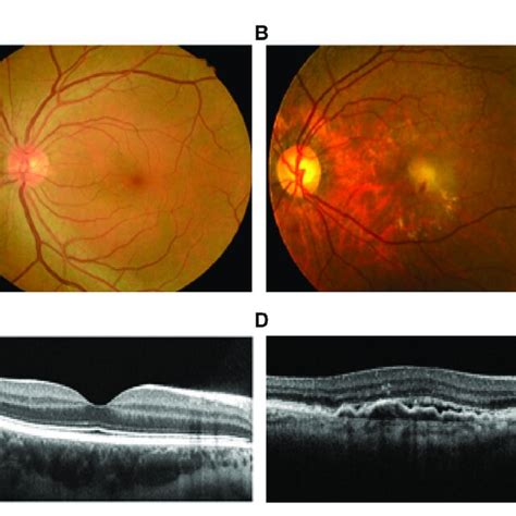 Comparison Of Health And Amd Human Retina A Normal Human Fundus