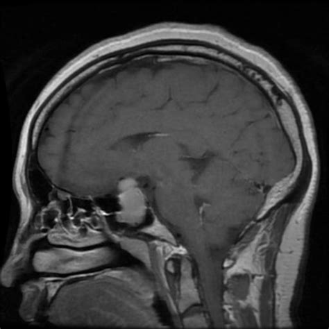 Tumor Classifier Object Detection Dataset And Pre Trained Model By Mayronworkspace