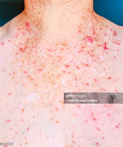 Psoriasis Scabs Psoriasis Pictures A Visual Guide To Psoriasis On