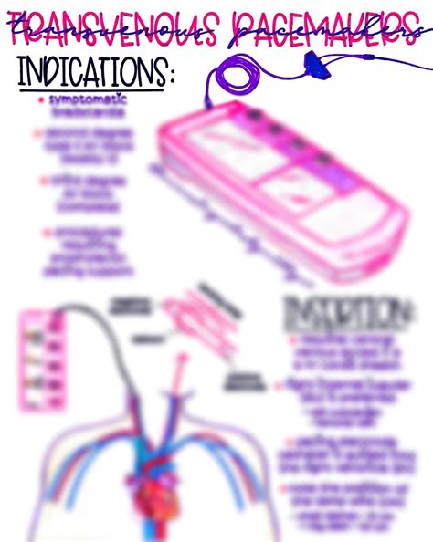 Transvenous Pacing Indications And Insertion Etsy