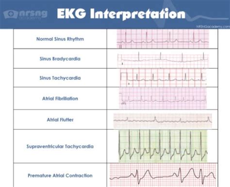 Printable Acls Cheat Sheet
