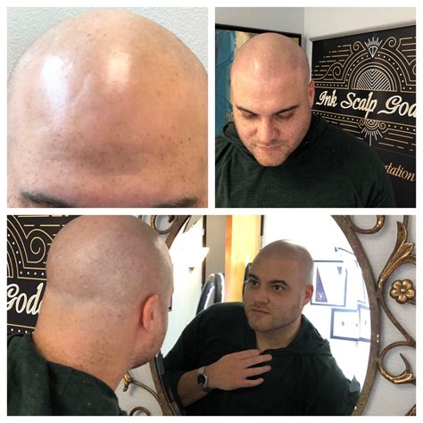 Scalp Micropigmentation The Modern Approach To Hair Restoration