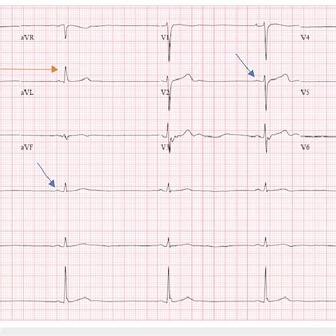 Ekg Done On Day 6 Showing Severe Sinus Bradycardia With A Heart Rate Of Download Scientific