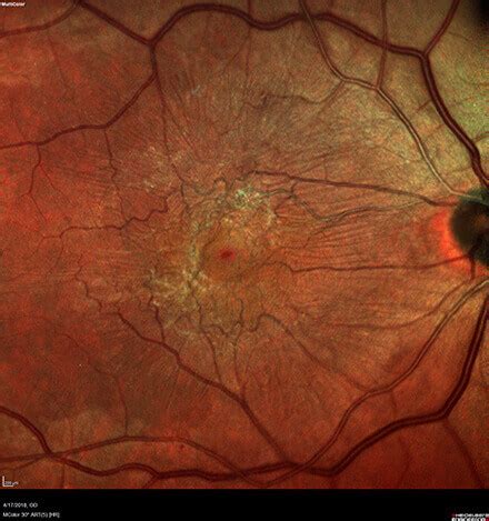 Erm Retina Epiretinal Membrane Surgery Outcome In Eyes With