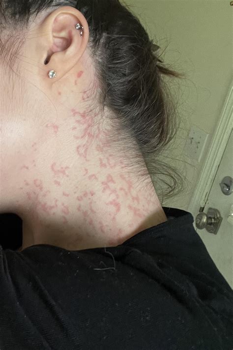 Anyone Else Seen Stress Hives Like This Rskincareaddicts