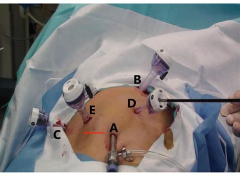 Laparoscopic Anterior Right Hepatectomy A Single Center Experience